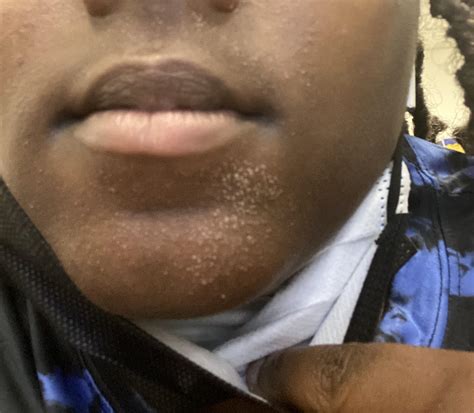 What Is This Rash Rdermatologyquestions