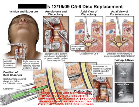 Amicus Illustration Of Amicussurgerycervicalspinediscreplacement