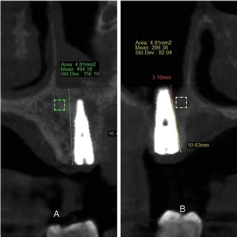 Figure 12 From Guided Maxillary Sinus Floor Elevation Using