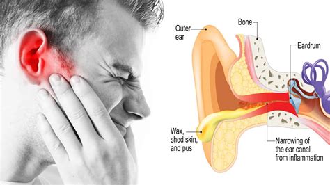 Doctors Reveal 6 Natural Remedies For Swimmers Ear 5 Minute Read