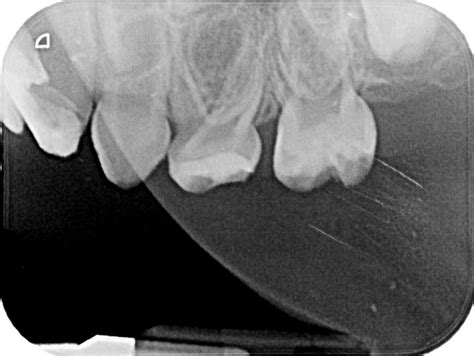 Glass Ionomer Cements For Primary Teeth Pediatric Dentistry Dental Jay