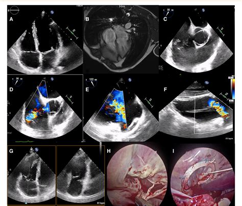 Figure 1 From Tricuspid Leaflet Flail After Micra™ Leadless Pacemaker Implantation A Case