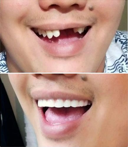 Instant Smile Comfort Fit Flex Natural Shade Upper Dental Veneer
