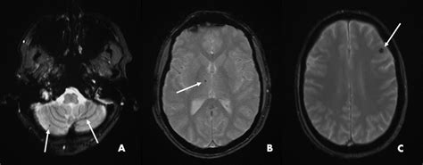 Cerebral Microbleeds White Arrows Highlight Cerebral Microbleeds Download Scientific Diagram