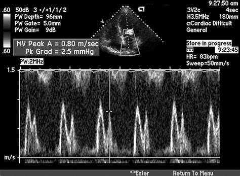 Mitral Inflow Pulsed Wave Doppler Recording On Follow Up Download