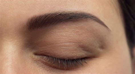 Eyelid Ptosis Sagging