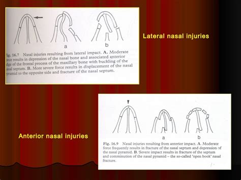 Classification Of Nasal Bone Fractures By Computed To