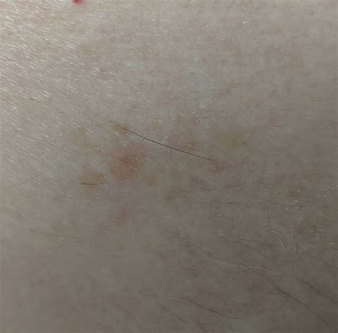 Small Patch Of Discolored Skin On Chest Dermatology