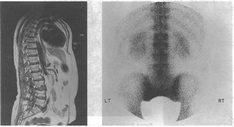 This Patient With Prostate Cancer Had A Normal Bone Scan And A Raised