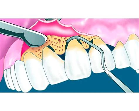 Cuál Es La Importancia De La Cirugía Periodontal 46 Off