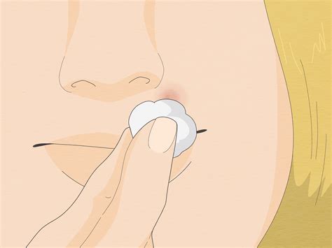 Simple Ways To Pop A Pimple Or Zit WikiHow