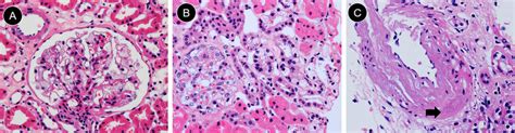 Light Microscopy Findings Of Fabry Nephropathy A Glomerular Lesion