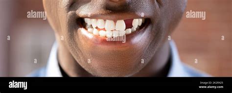 Missing Teeth Man Hi Res Stock Photography And Images Alamy
