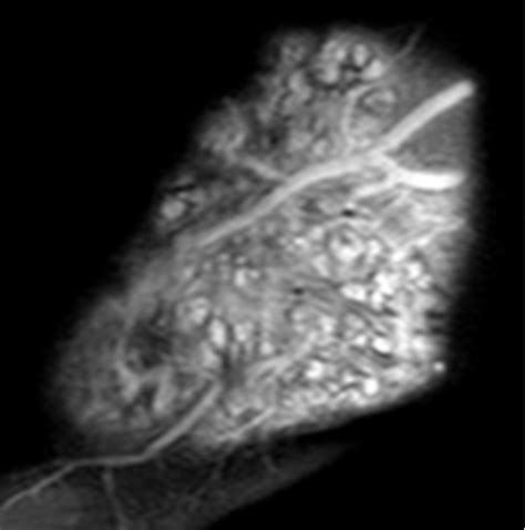 Pdf Madura Foot Masquerading As A Hemangioma Semantic Scholar