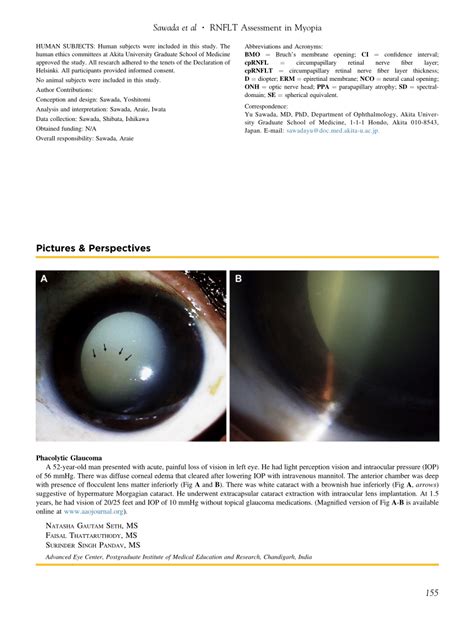 Pdf Phacolytic Glaucoma