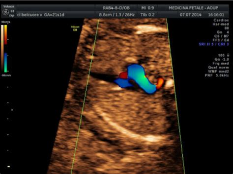 Aberrant Right Subclavian Artery Arsa Download Scientific Diagram