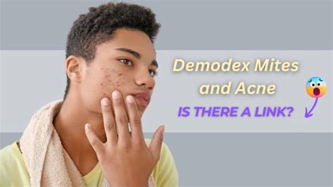 An Overview To Demodex Mites Treatment Ozidex