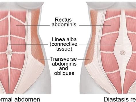 Rectus Divarication Norfolk And Waveney Community Musculoskeletal