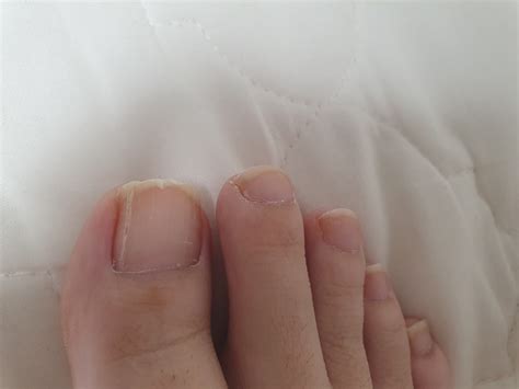 엄지발톱 세로 금 치료방법 있을까요 ㅣ 궁금할 땐 아하