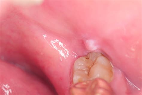 Canker Sore On Cheek Near Wisdom Tooth Wisdom Teeth Removal Explained