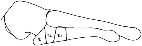 Fifth Metatarsal Fractures Clinics In Podiatric Medicine And Surgery