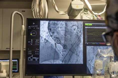 Istanbul Turkey February 29 2024 X Ray For Valvular Replacement With