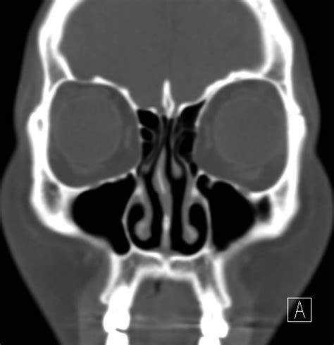 High Septal Deviation To The Right Side Download Scientific Diagram