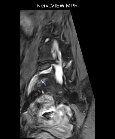 Mri Nerve Visualization Informs Surgery Fieldstrength Philips