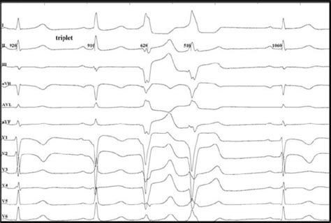 Spontaneous Triplet Pvcs With First Fusion Beat Note V3 And V4 Were