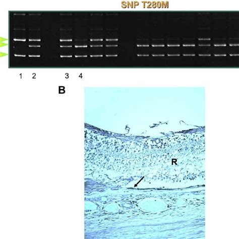 Hard And Soft Drusen A Hard Drusen A Small Discrete Punctate