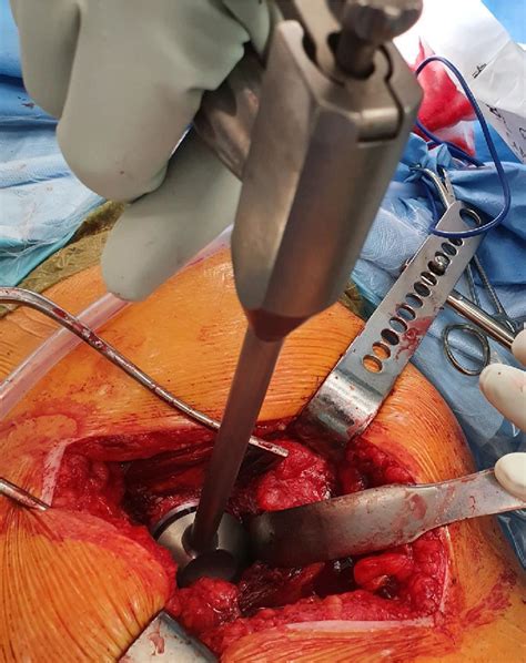 Acetabular Component Insertion Using A Holder Download Scientific