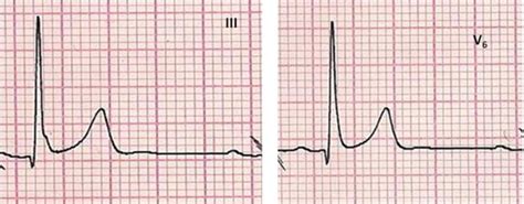 ST Segment Elevation Defined By The Company It Keeps Mayo Clinic