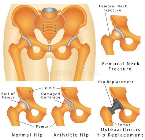 Types De Fracture De Hanche Illustration De Vecteur Illustration Du