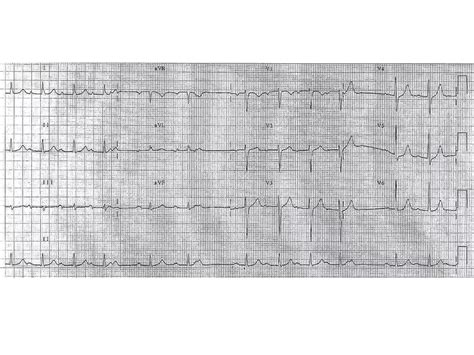 Ecg Lecture Sinus Arrest Sinoatrial Exit Block Av Block And Escape