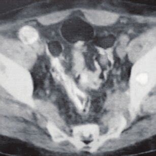 Computed Tomography Scans Showed A Tumor In The Pancreatic Tail With