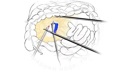图解 全腹腔镜下右半结肠切除术”升结肠