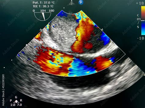Transesophageal Echocardiogram Tee Shown Left Atrial La Myxoma