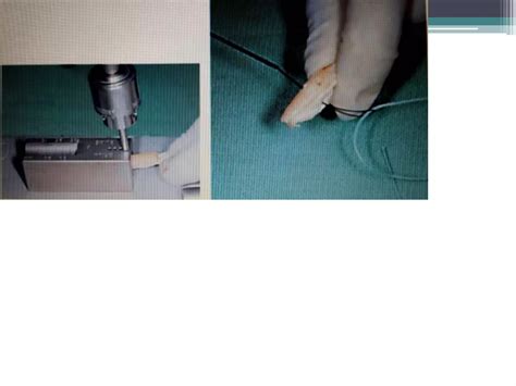 Acl Reconstruction Quadrapled Hamstring Graft Pptx