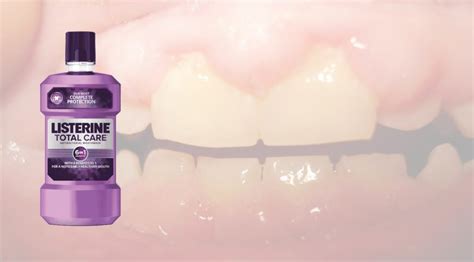 Gingival Hyperplasia Causes Symptoms And Treatment