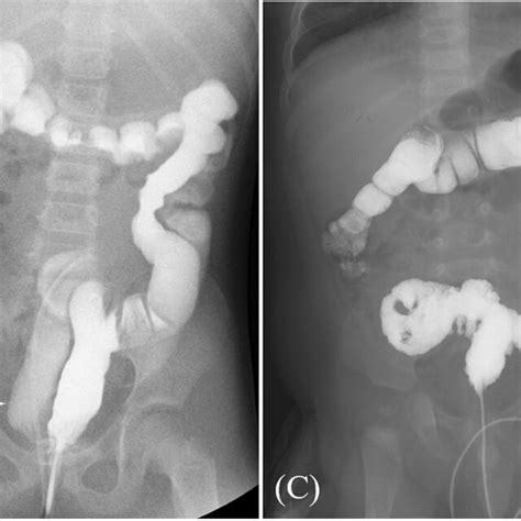Comparison Between Distal Colostogram And The Automatically 3d