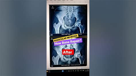 Avn Bone Repair Regenerate And Regrow By Robotic Laser And Fswt