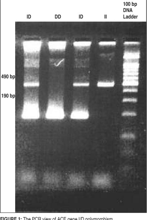 Figure 1 From Relationship Between Angiotensin Converting Enzyme Gene Polymorphism Insertion