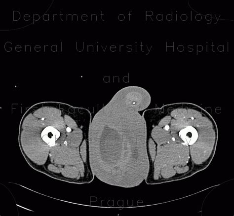 Radiology Case Complication Of Angiography Bleeding From Groin