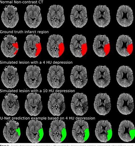 Figure 1 From Optimizing Deep Learning Algorithms For Segmentation Of