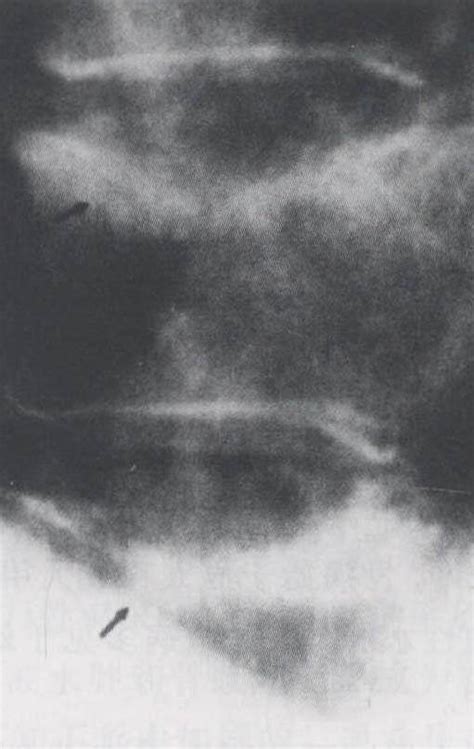 皮质醇增多症 关节病影像诊断