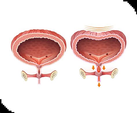 Women Bladder Dysfunction Treatment Services Omansh