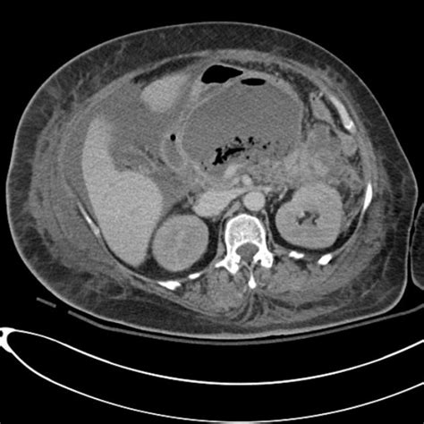 Pancreatic Necrosis Radiology