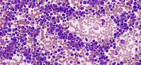 Cml In Chronic Phase Learnhaem Haematology Made Simple