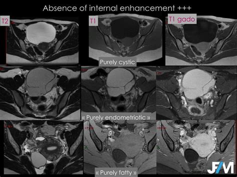 Selma Beljord Diffusion Perfusion Mri In Ovarian Lesions Jfim Ifupi