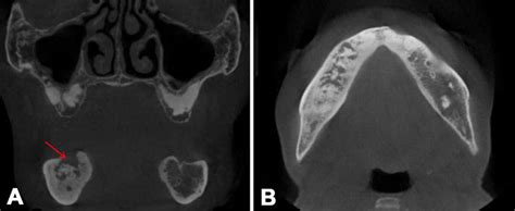 A Coronal Reconstruction Showing Amorphous Hyperdense Images In The